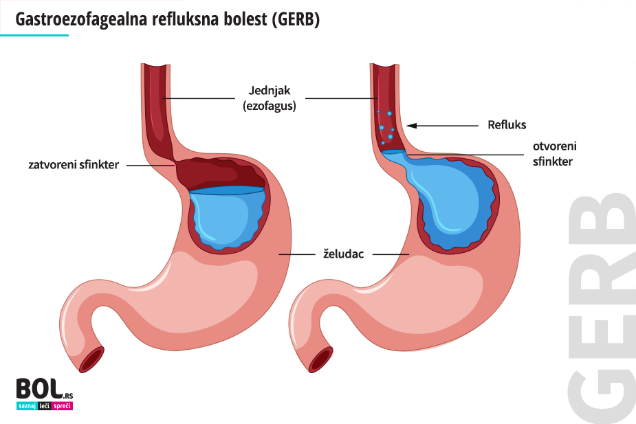 GERB: Simptomi, uzroci i lečenje refluksne bolesti | Bol.rs